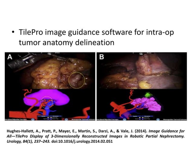 Laparoscopic Partial nephrectomy | PPTX | Surgery | Medical Health