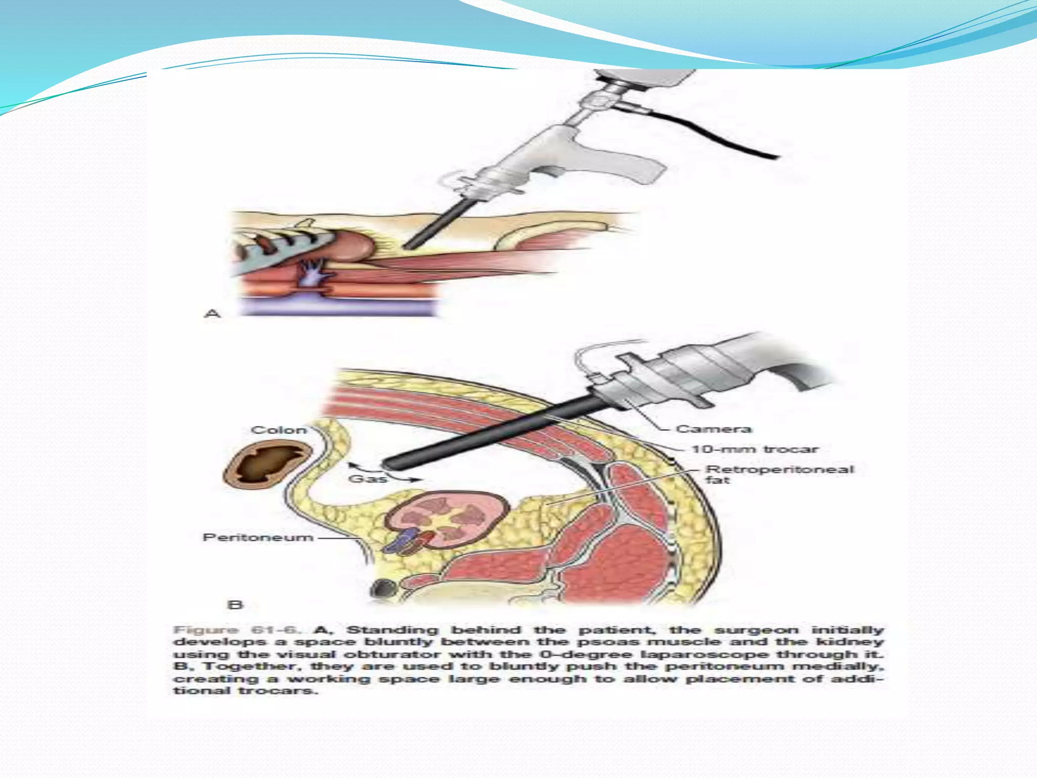 Lap pyeloplasty | PPTX
