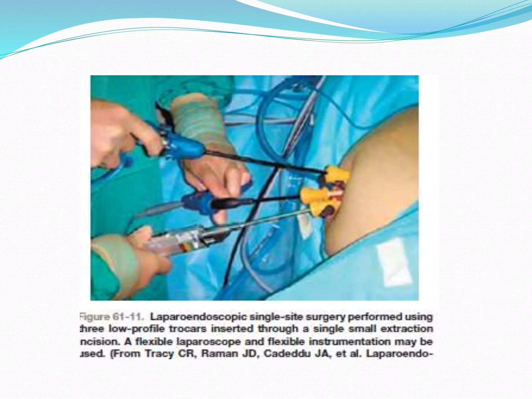 Lap pyeloplasty | PPTX