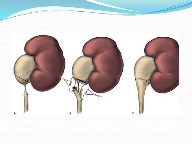 Lap pyeloplasty | PPTX | Digestive Disorders | Diseases and Conditions
