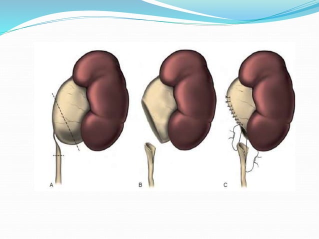 Lap pyeloplasty | PPT