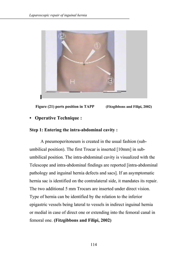 Laparoscopic Inguinal Hernia Repair Seal Approach
