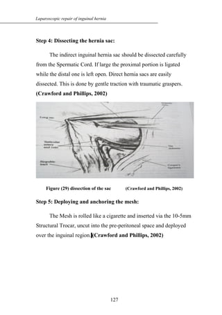 Laparoscopic Inguinal Hernia Repair Seal Approach