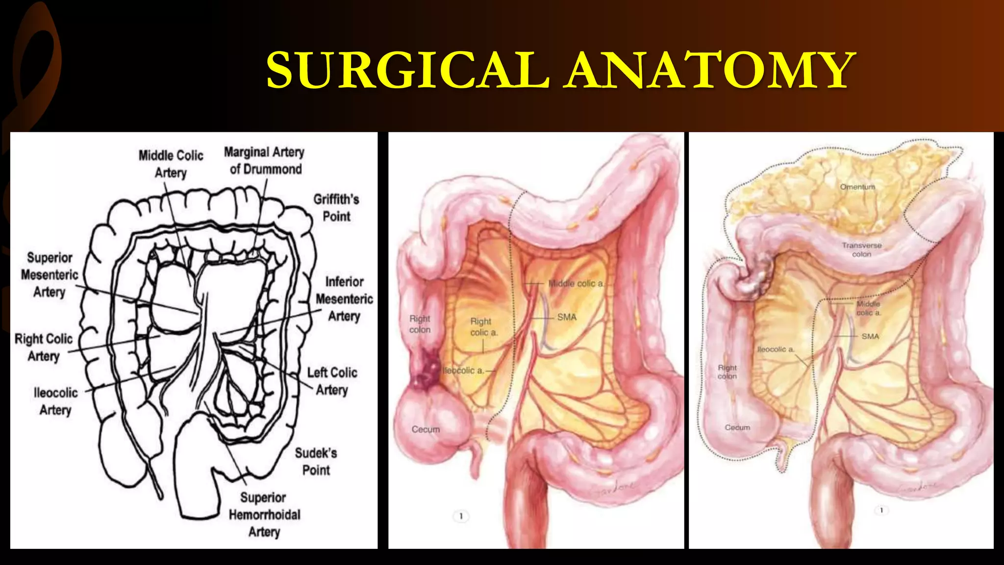 LAP RIGHT HEMICOLECTOMY-STEP BY STEP Operative Surgery.pptx