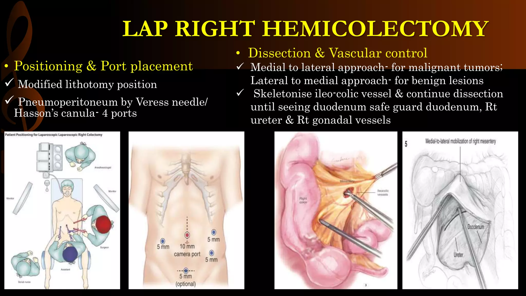 LAP RIGHT HEMICOLECTOMY-STEP BY STEP Operative Surgery.pptx