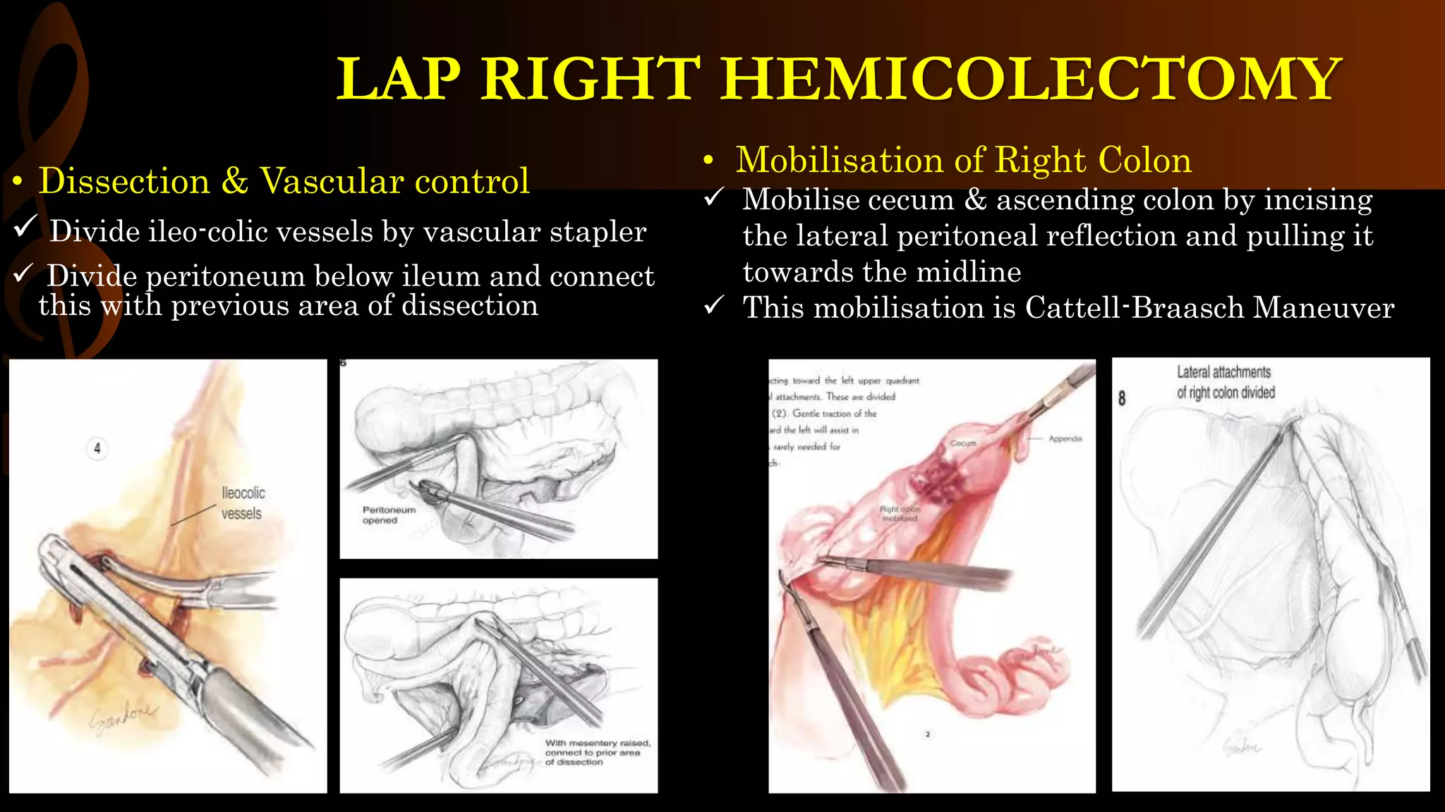 LAP RIGHT HEMICOLECTOMY-STEP BY STEP Operative Surgery.pptx