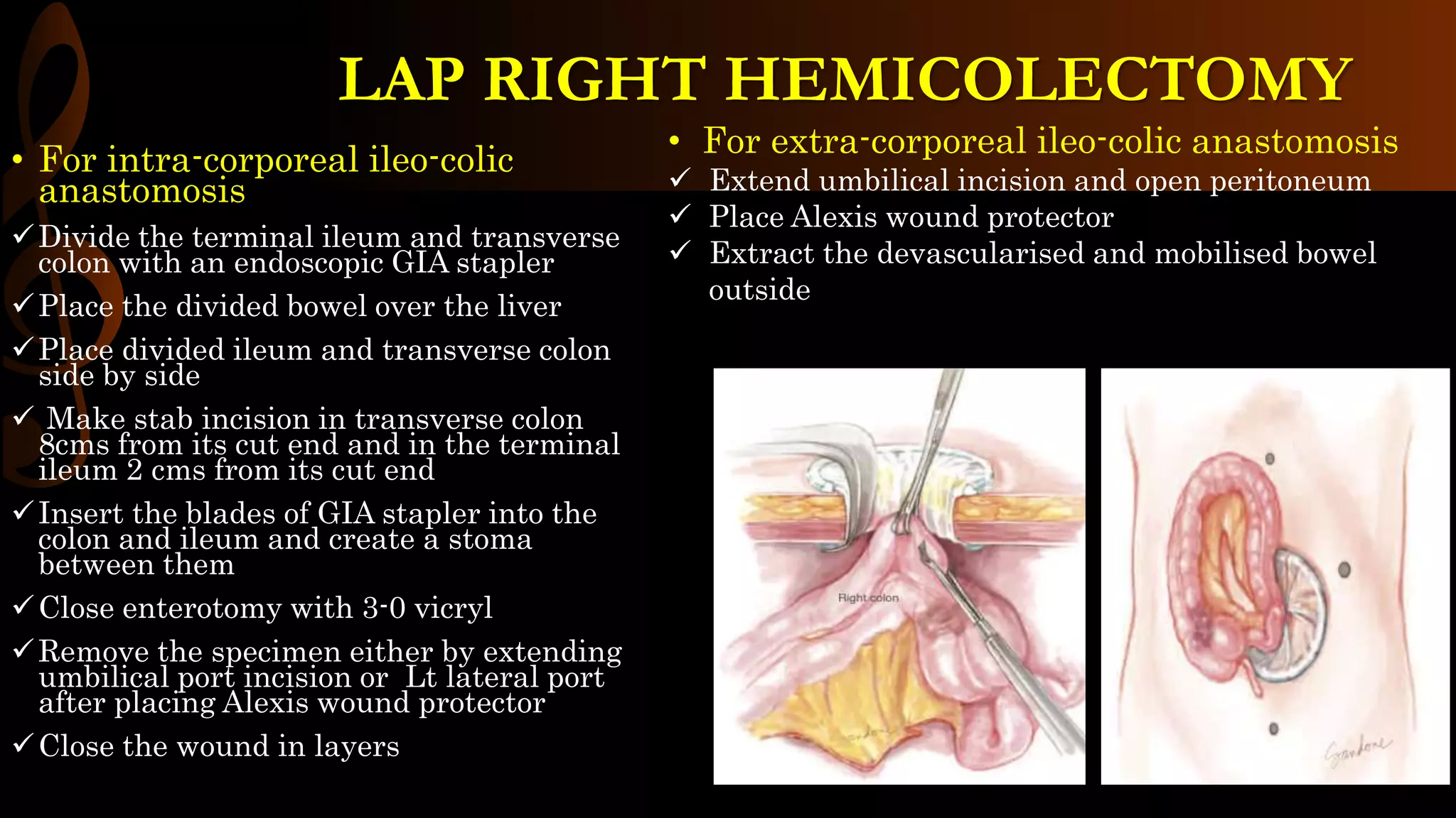 LAP RIGHT HEMICOLECTOMY-STEP BY STEP Operative Surgery.pptx