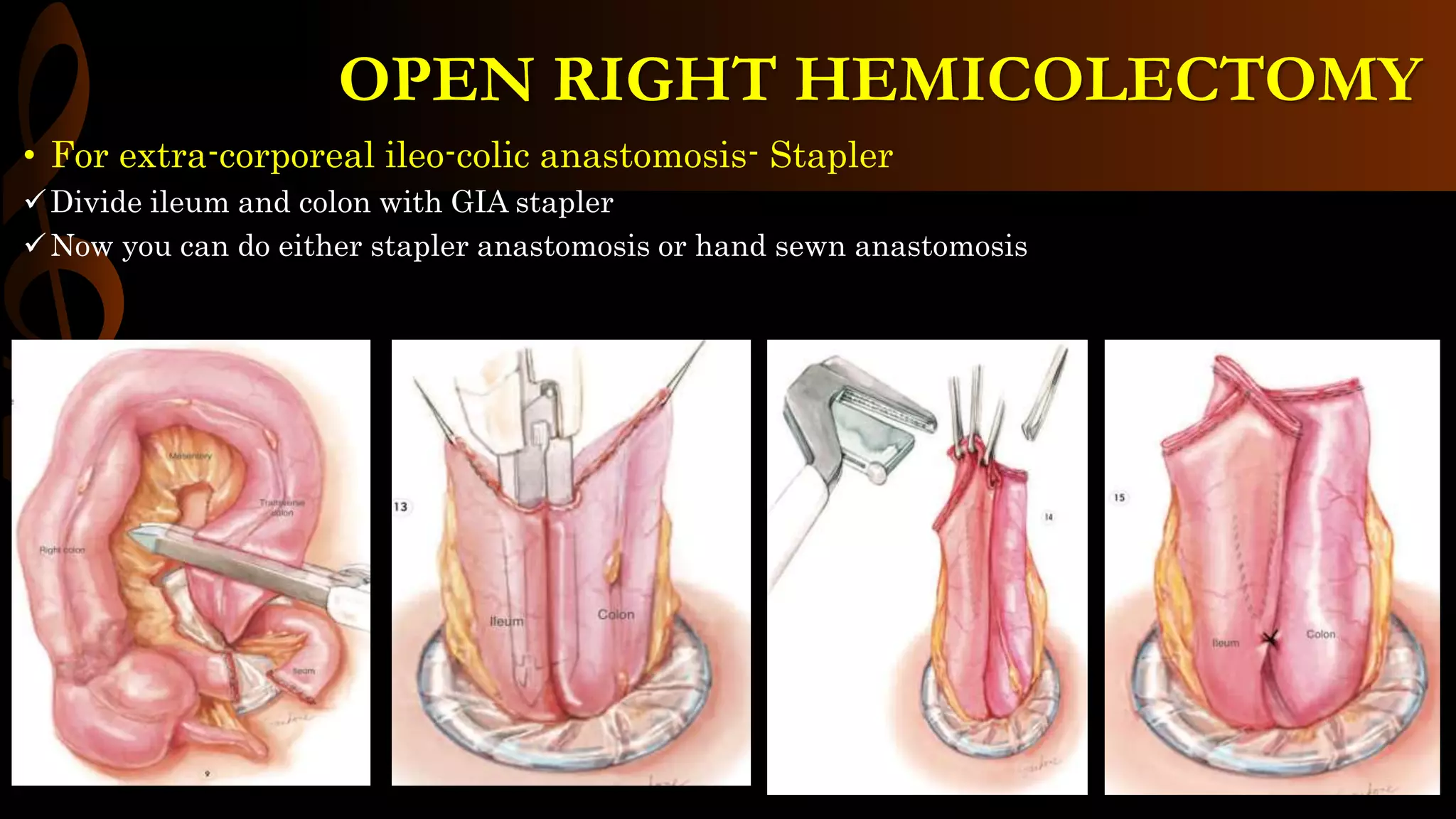 LAP RIGHT HEMICOLECTOMY-STEP BY STEP Operative Surgery.pptx