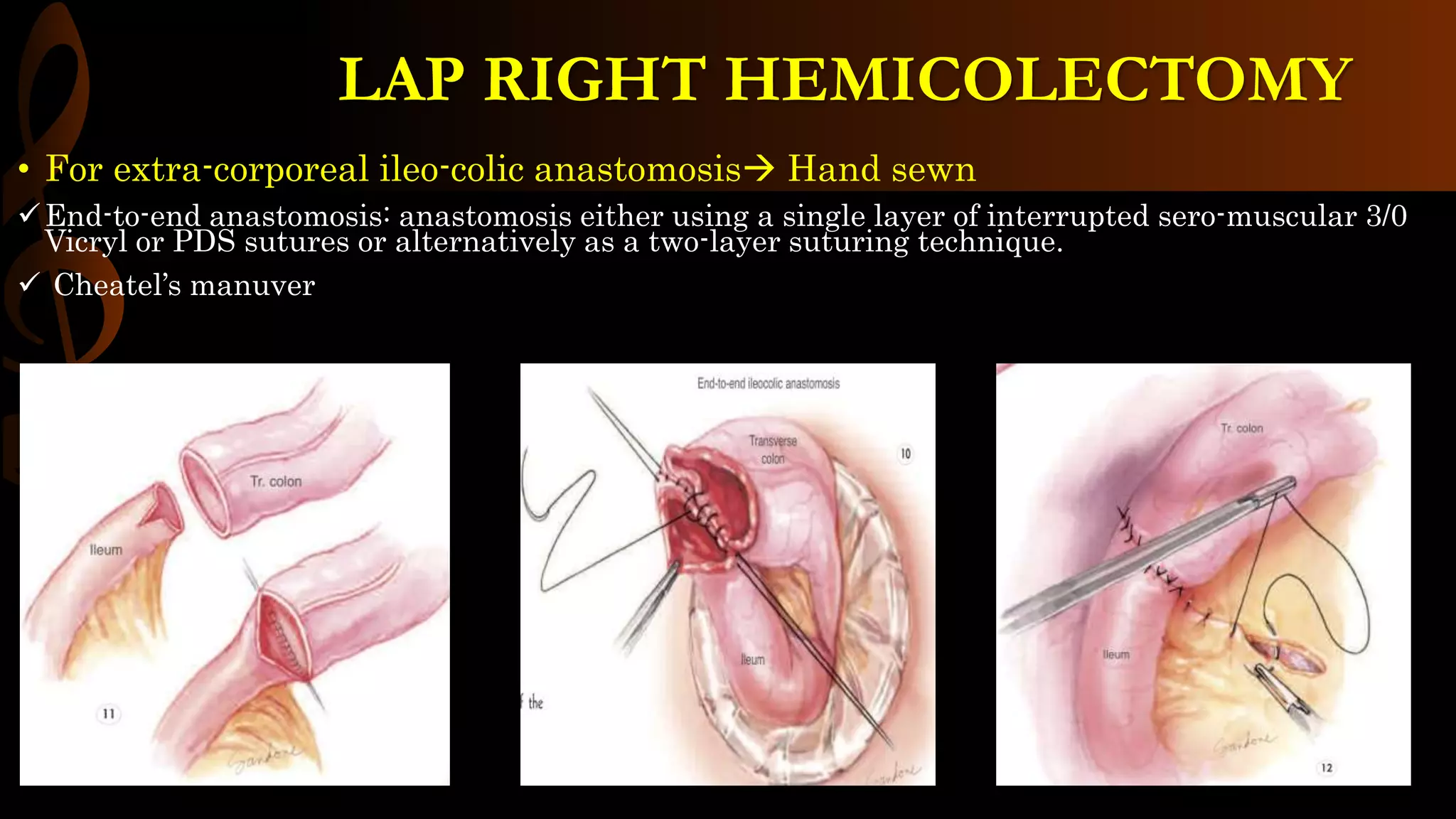 LAP RIGHT HEMICOLECTOMY-STEP BY STEP Operative Surgery.pptx