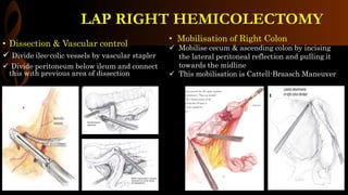 LAP RIGHT HEMICOLECTOMY-STEP BY STEP Operative Surgery.pptx