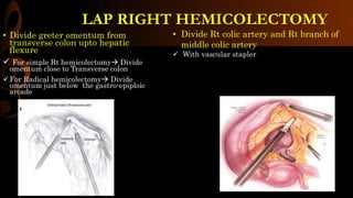 LAP RIGHT HEMICOLECTOMY-STEP BY STEP Operative Surgery.pptx