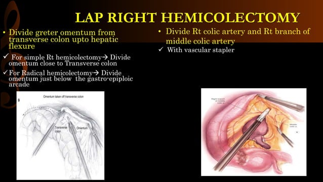 LAP RIGHT HEMICOLECTOMY-STEP BY STEP Operative Surgery.pptx