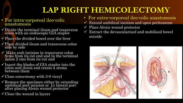 LAP RIGHT HEMICOLECTOMY-STEP BY STEP Operative Surgery.pptx