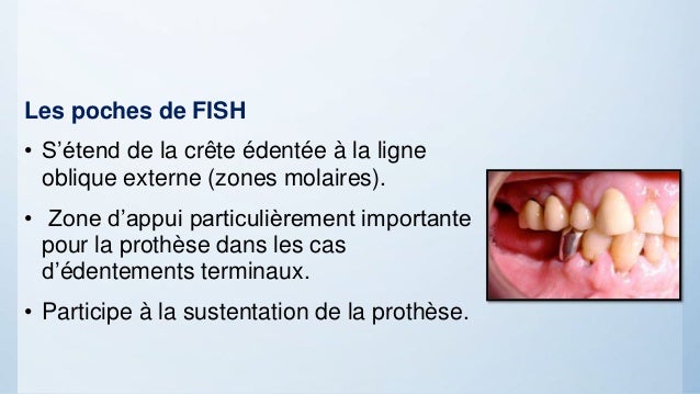 La prothèse partielle en résine