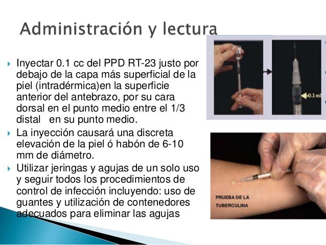 La prueba de la tuberculina