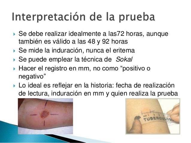 La prueba de la tuberculina