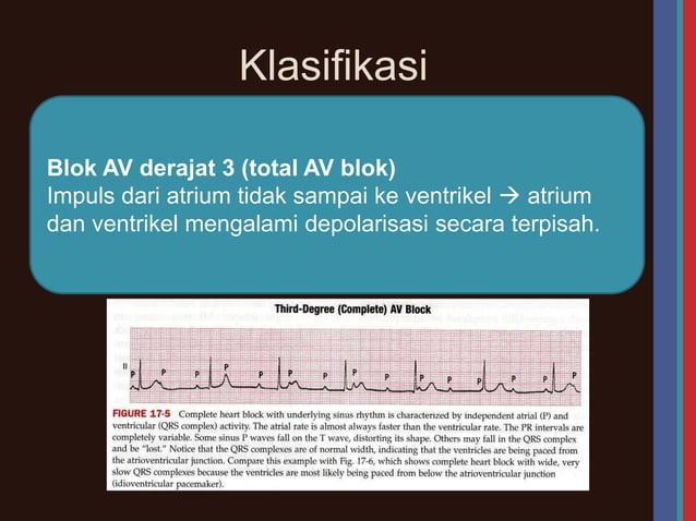 Total AV Block .pptx