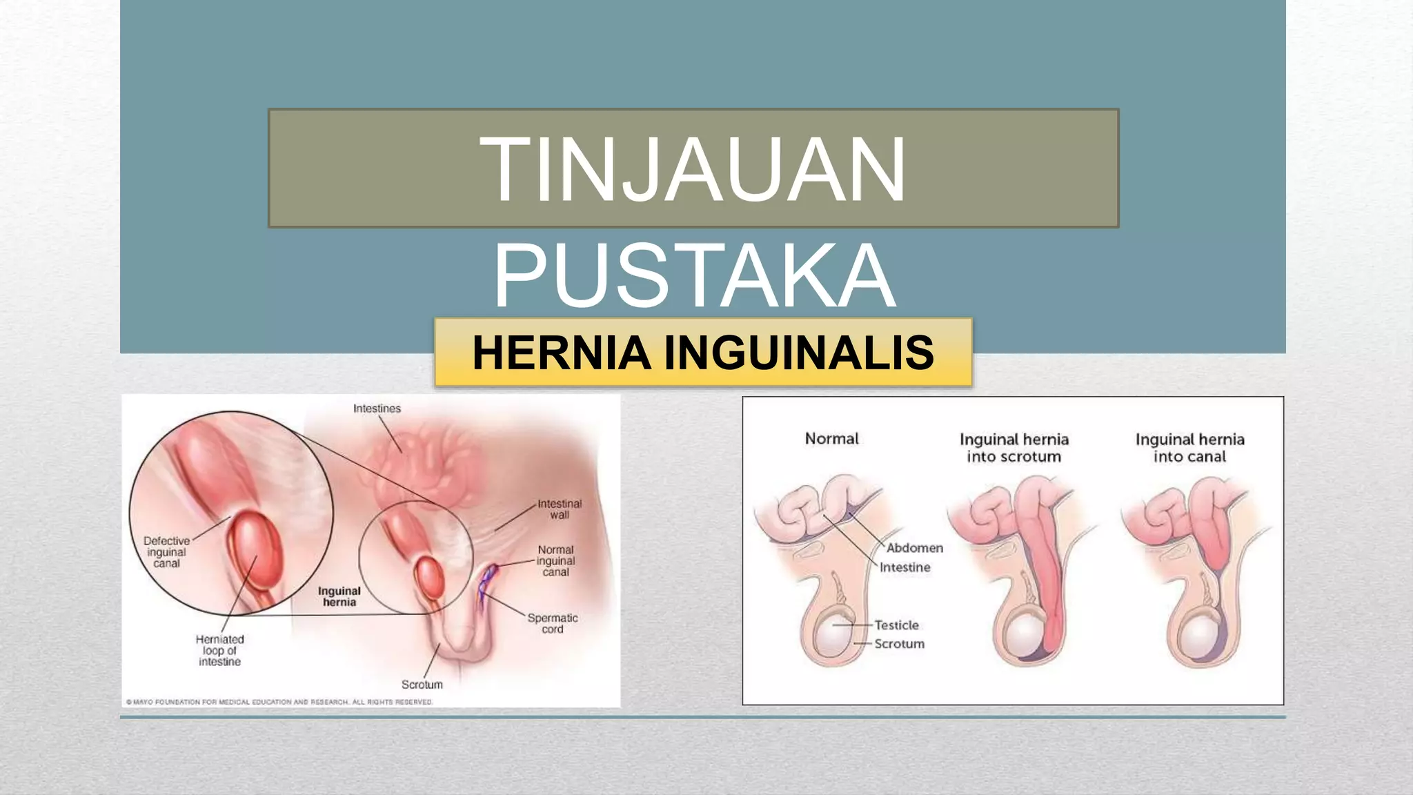 Lapsus hidrocel | PPTX