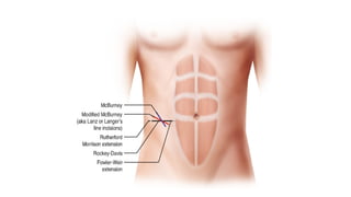 Lapsus appendicitisAppendicitis terbaru d | PPTX