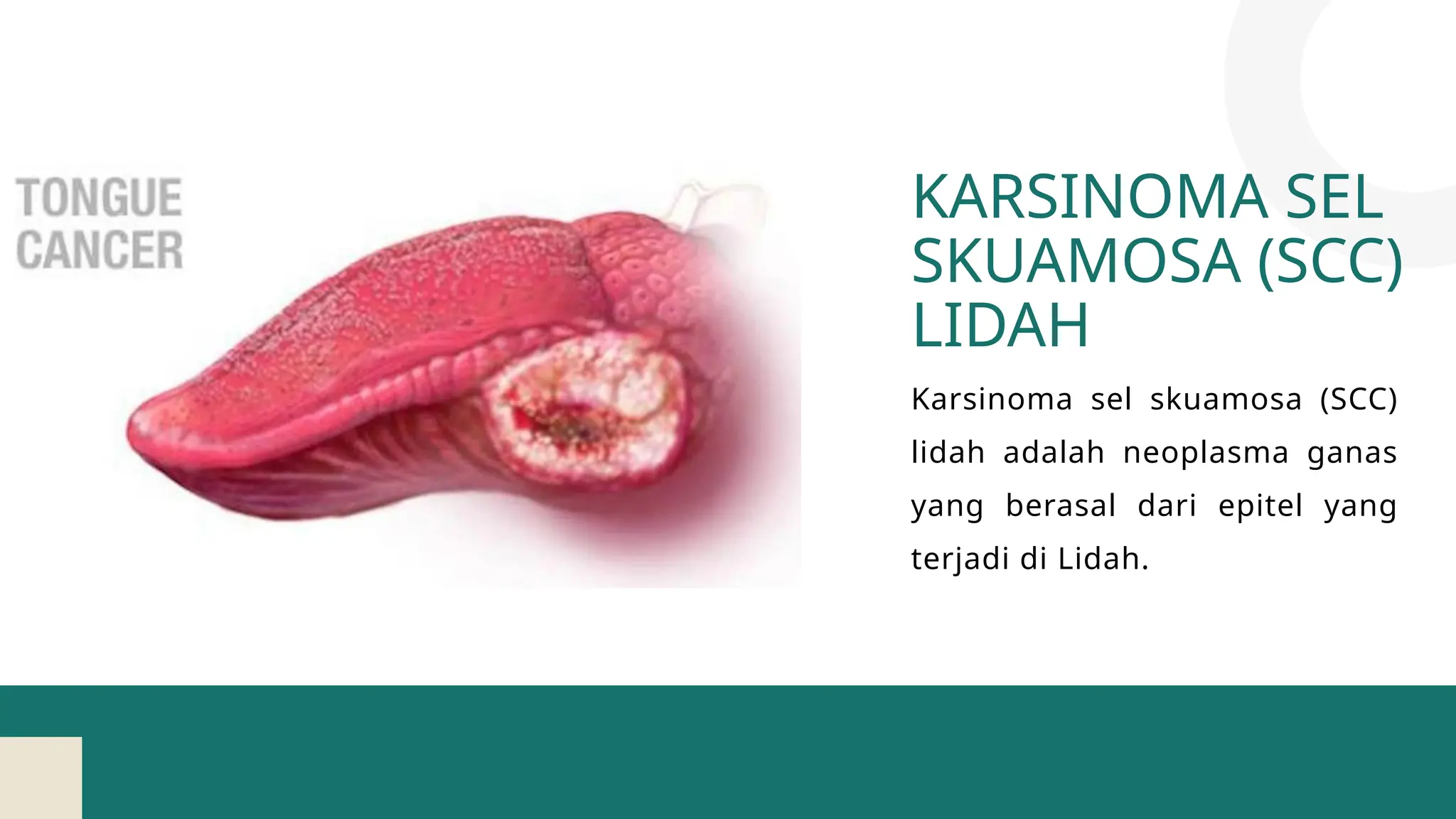 Laporan Kasus Tongue Squamous Cell Carcinoma | PPTX