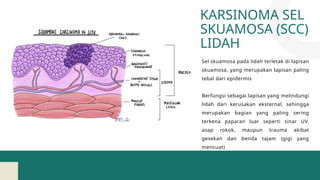 Laporan Kasus Tongue Squamous Cell Carcinoma | PPTX