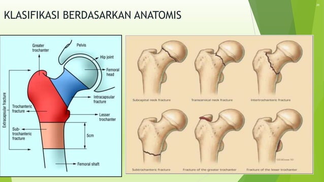 Lapsus CF Collum Femur.ppt