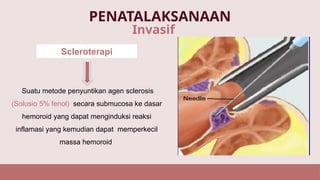 Laporan kasus Hemoroid interna internsip .pptx