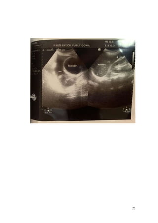 Lapsus kolelitiasis | DOCX