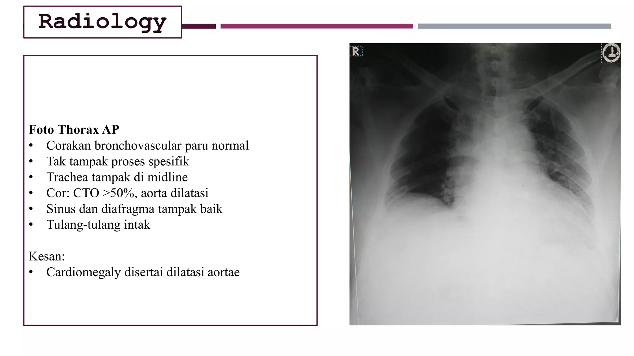 Kesadaran Menurun ec Hemoragik Stroke | PDF
