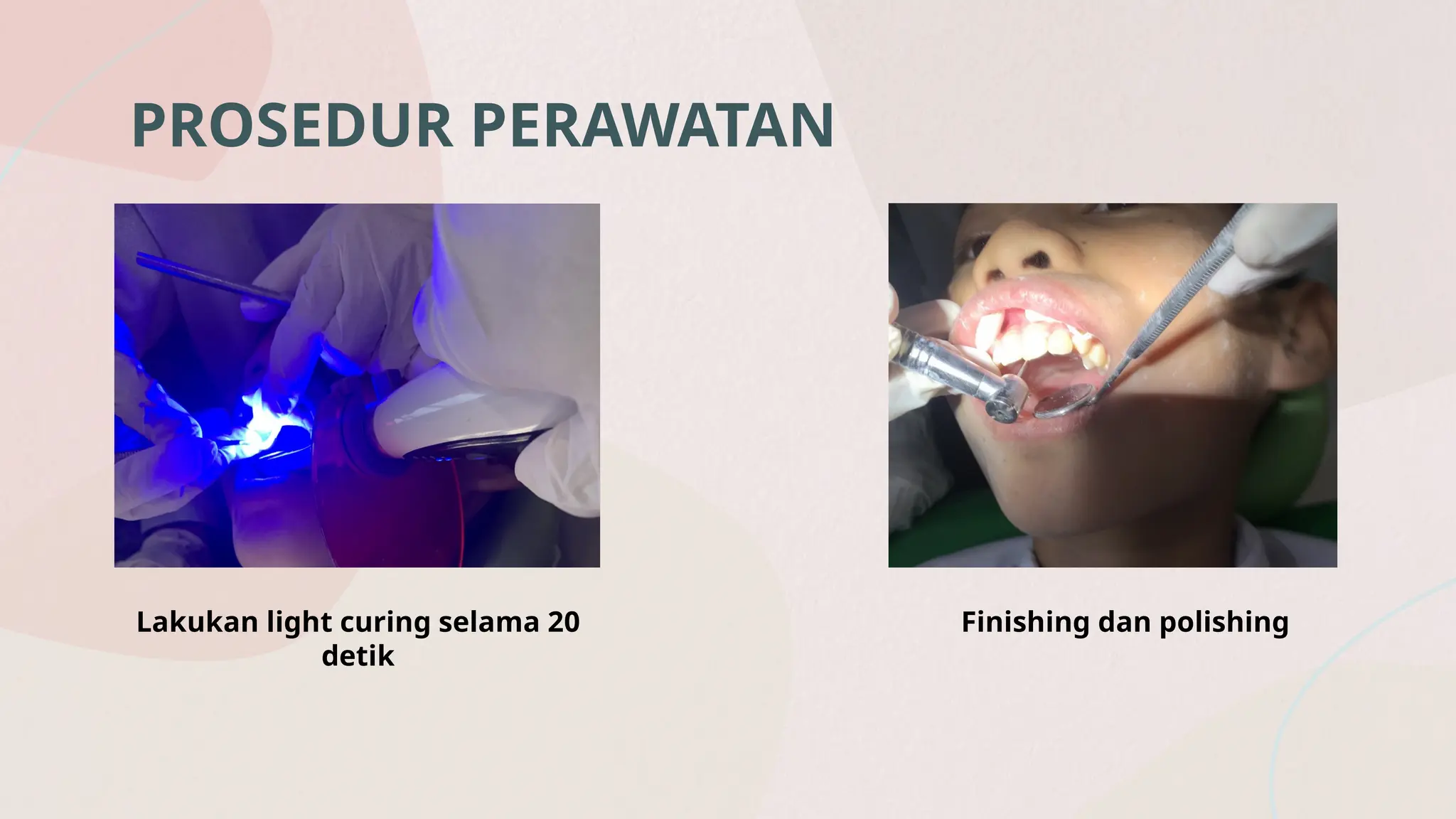LAPSUS RESTORASI KOMPOSIT KLAS III GIGI 21.pptx