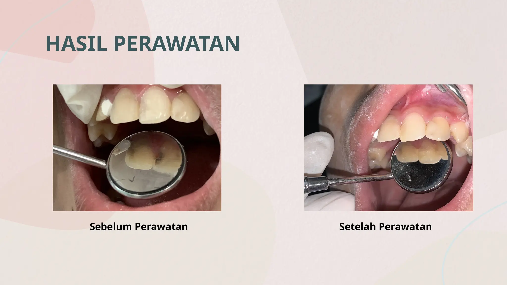 LAPSUS RESTORASI KOMPOSIT KLAS III GIGI 21.pptx