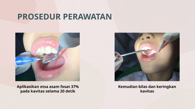 LAPSUS RESTORASI KOMPOSIT KLAS III GIGI 21.pptx