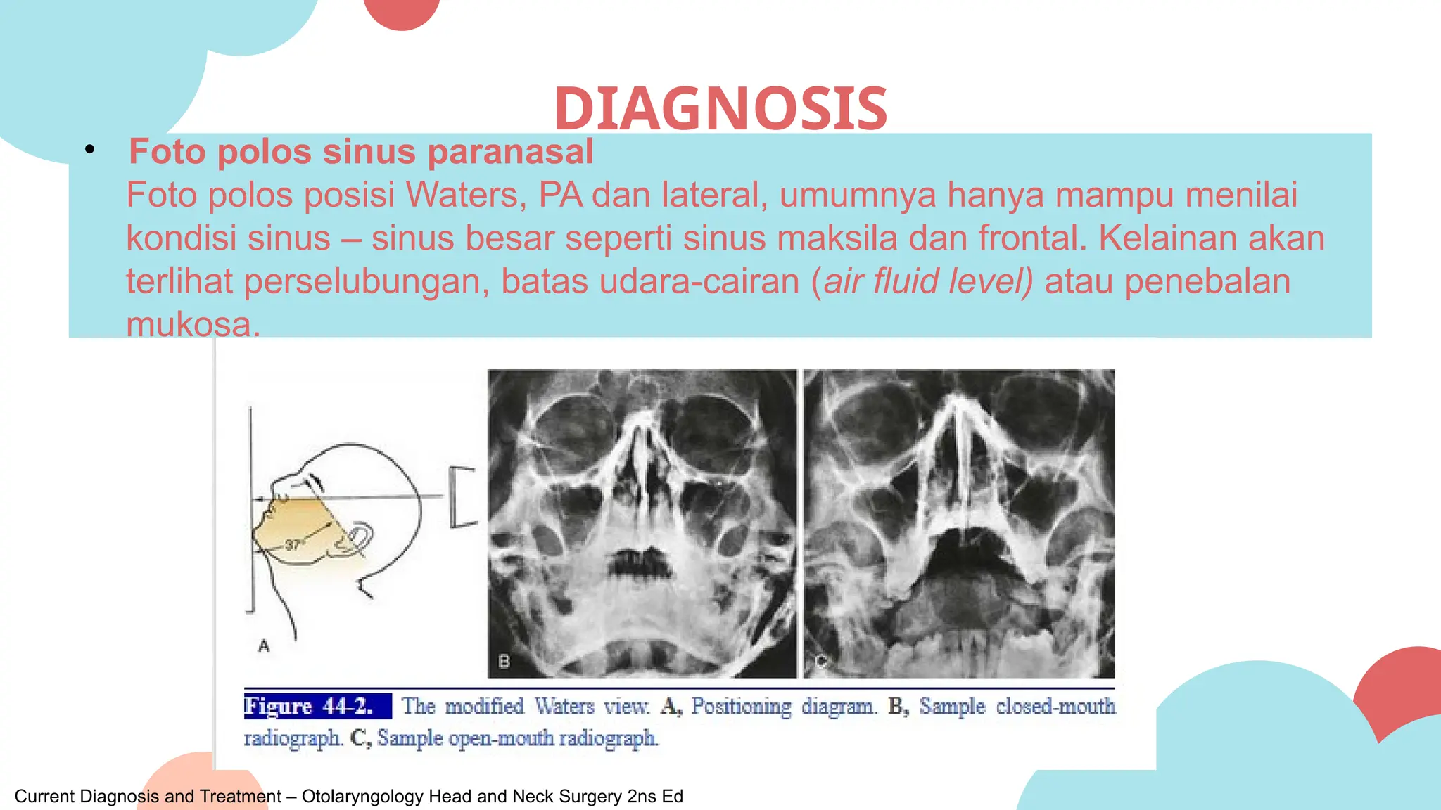 Lapsus risyay SINUSITIS -2.pptx nnnnnnnnn | PPTX