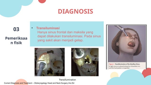 Lapsus risyay SINUSITIS -2.pptx nnnnnnnnn | PPT