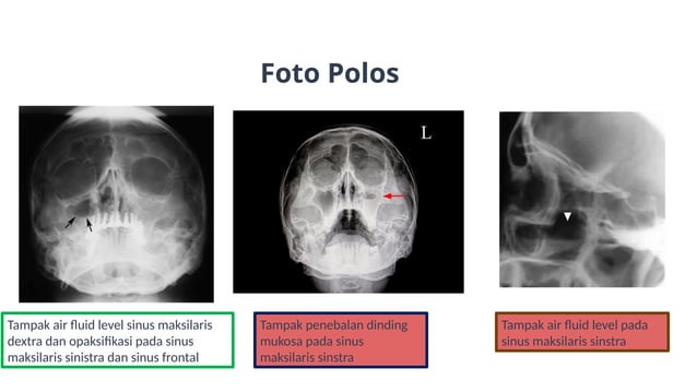 Lapsus risyay SINUSITIS -2.pptx nnnnnnnnn | PPT