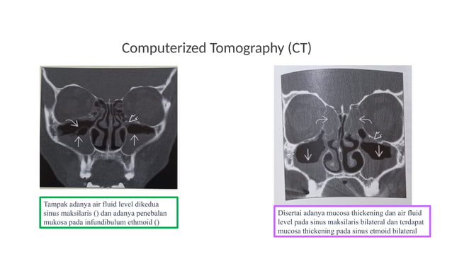 Lapsus risyay SINUSITIS -2.pptx nnnnnnnnn | PPT