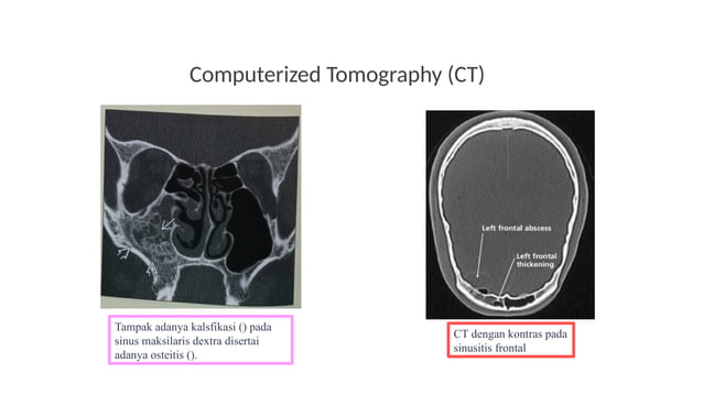 Lapsus risyay SINUSITIS -2.pptx nnnnnnnnn | PPT
