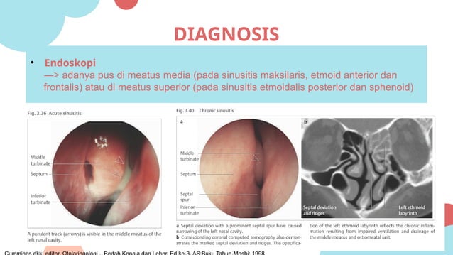 Lapsus risyay SINUSITIS -2.pptx nnnnnnnnn | PPT