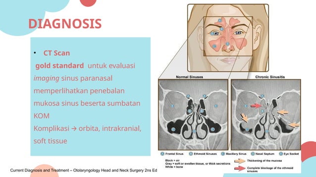 Lapsus risyay SINUSITIS -2.pptx nnnnnnnnn | PPT