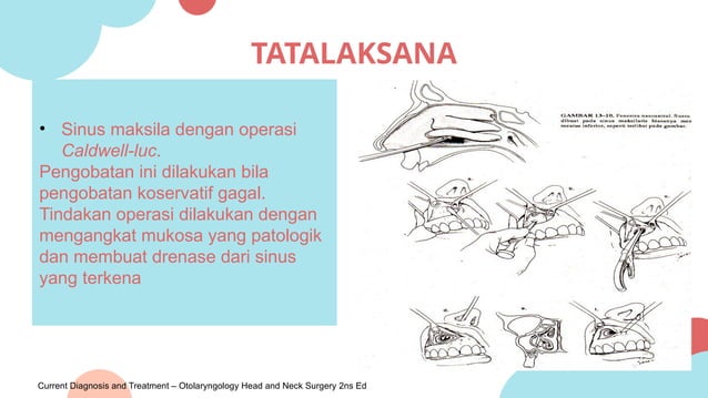 Lapsus risyay SINUSITIS -2.pptx nnnnnnnnn | PPT