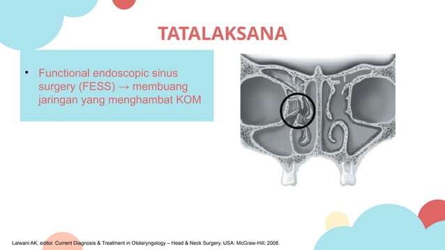 Lapsus risyay SINUSITIS -2.pptx nnnnnnnnn | PPT
