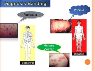 Lapsus varicella | PPTX