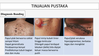 Veruka vulgaris | PPTX