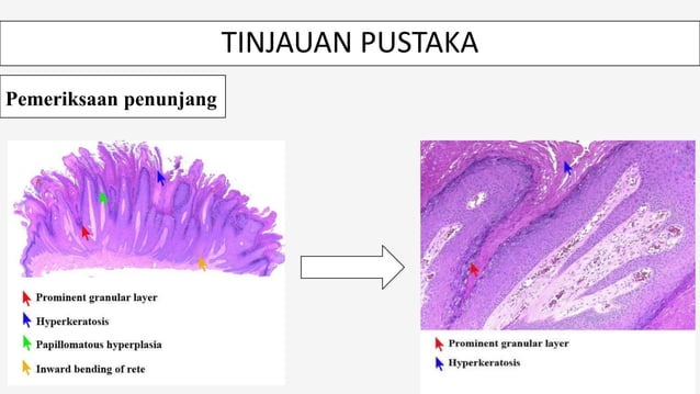 Veruka vulgaris | PPTX