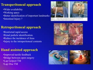 LAPAROSCOPIC UROLOGICAL SURGERY | PPTX