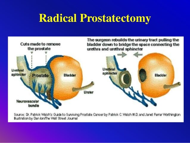 Radical Prostatectomy Procedure