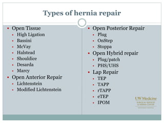 Inguinal Hernia Repair Shouldice