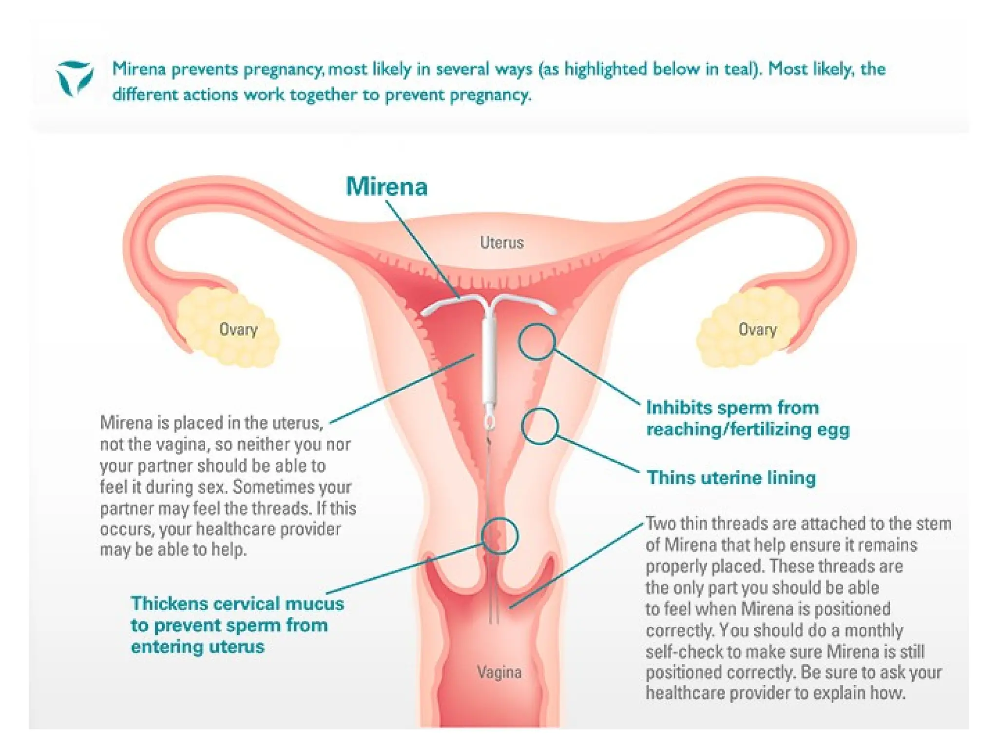 LARCs_Presentation (1).pptx long acting reversible contraceptives | PPTX
