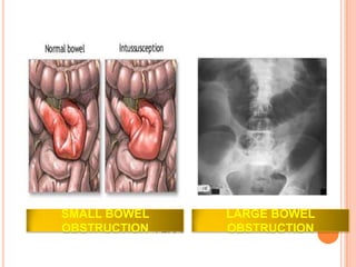 Large bowel obs | PPTX