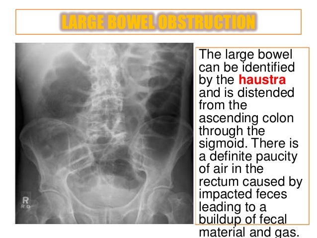Large bowel obstruction
